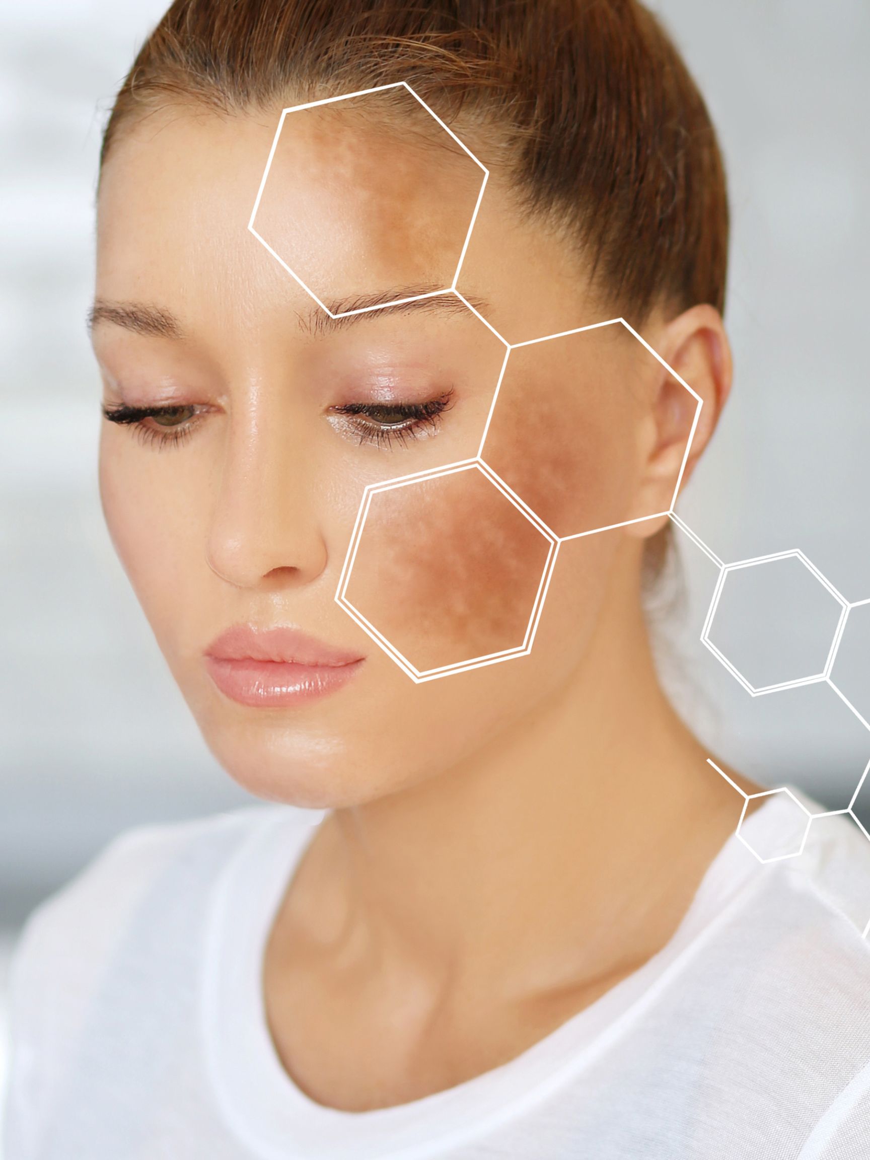 What is the Best Treatment for Melasma? | Rockville, MarylandW Med Spa